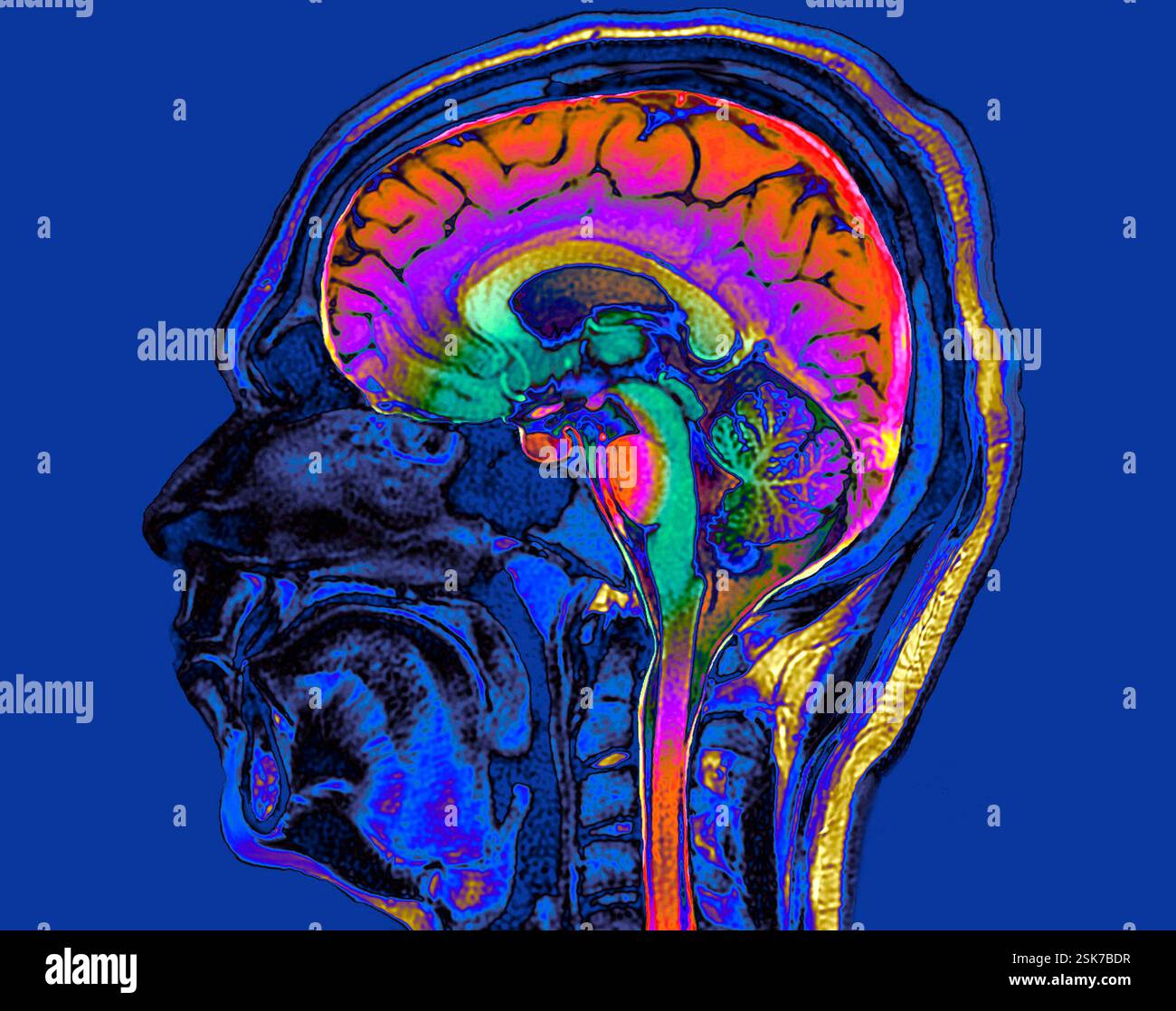 Human head and brain. Coloured sagittal magnetic resonance imaging (MRI ...