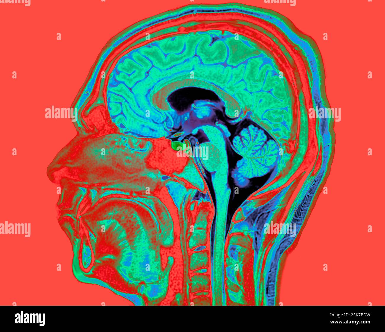 Human head and brain. Coloured sagittal magnetic resonance imaging (MRI ...