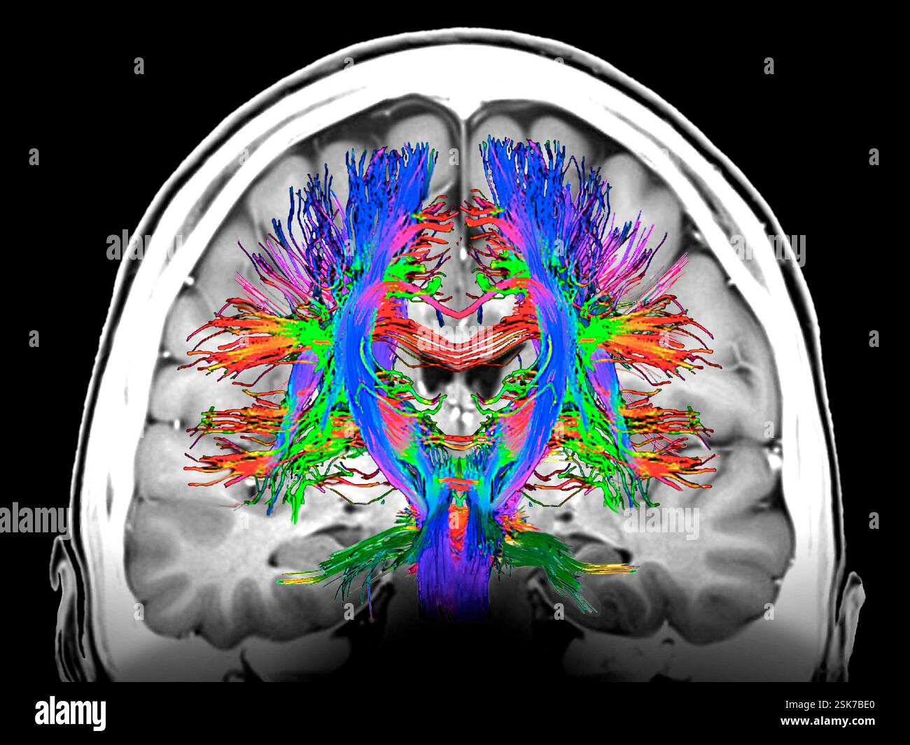 Brain Fibres And Structures 3d Diffusion Tensor Imaging Dti Magnetic Resonance Imaging Mri