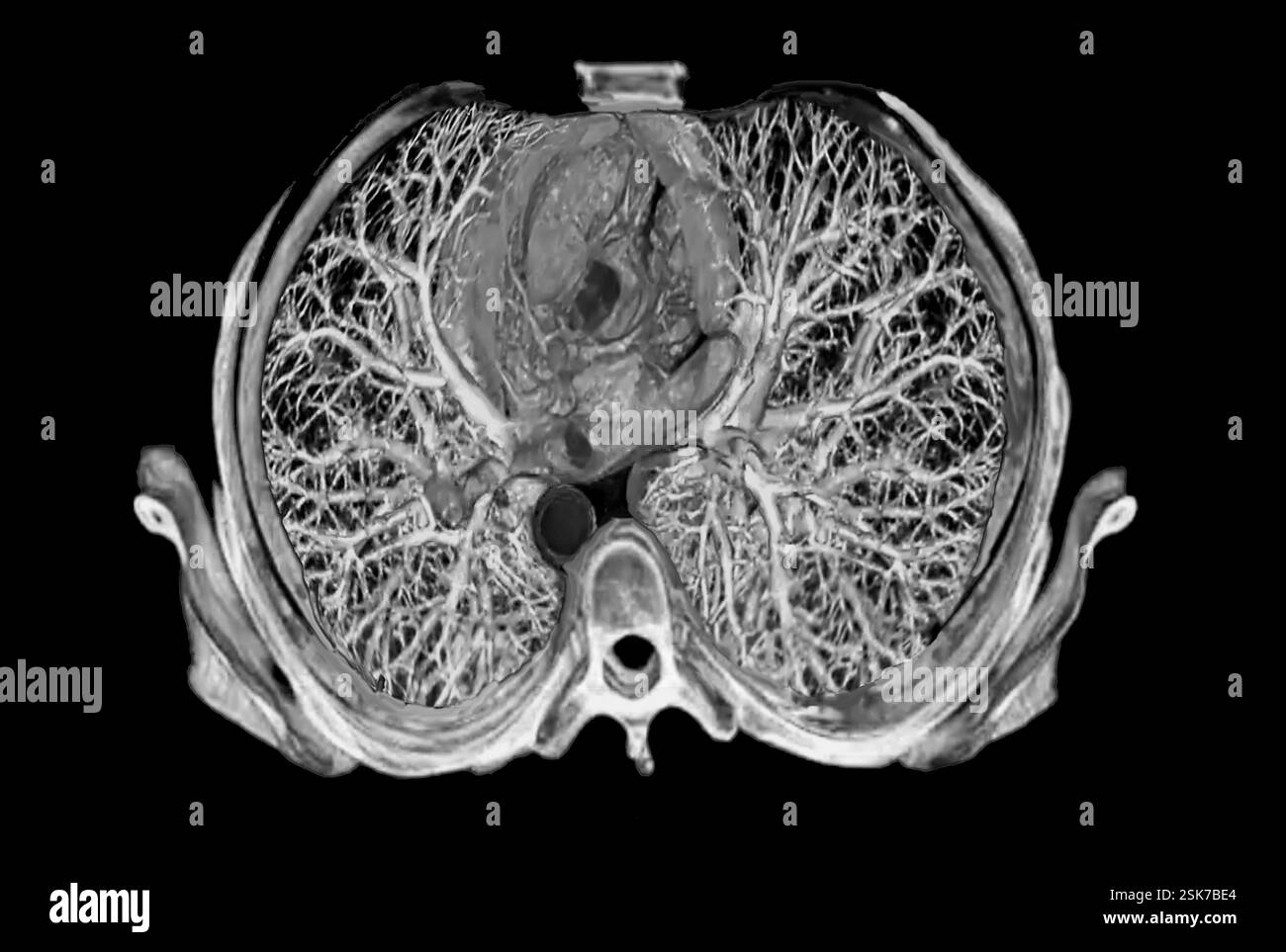 Bronchial tree. 3D computed tomography (CT) scan of the bronchi in the ...