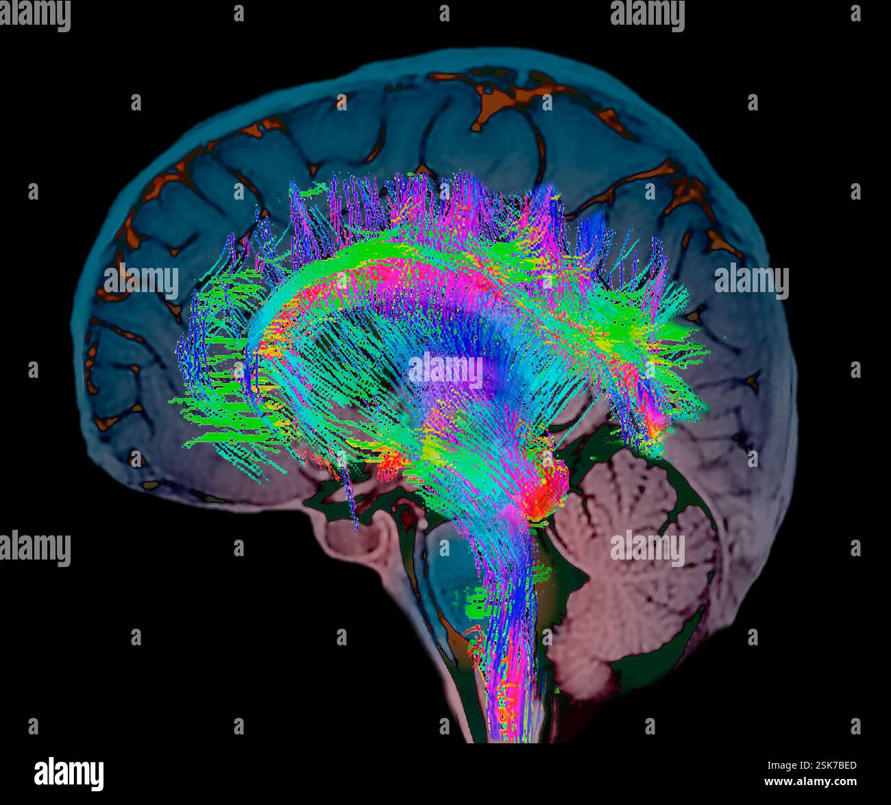 Brain fibres and structures. 3D diffusion tensor imaging (DTI) magnetic resonance imaging (MRI ...