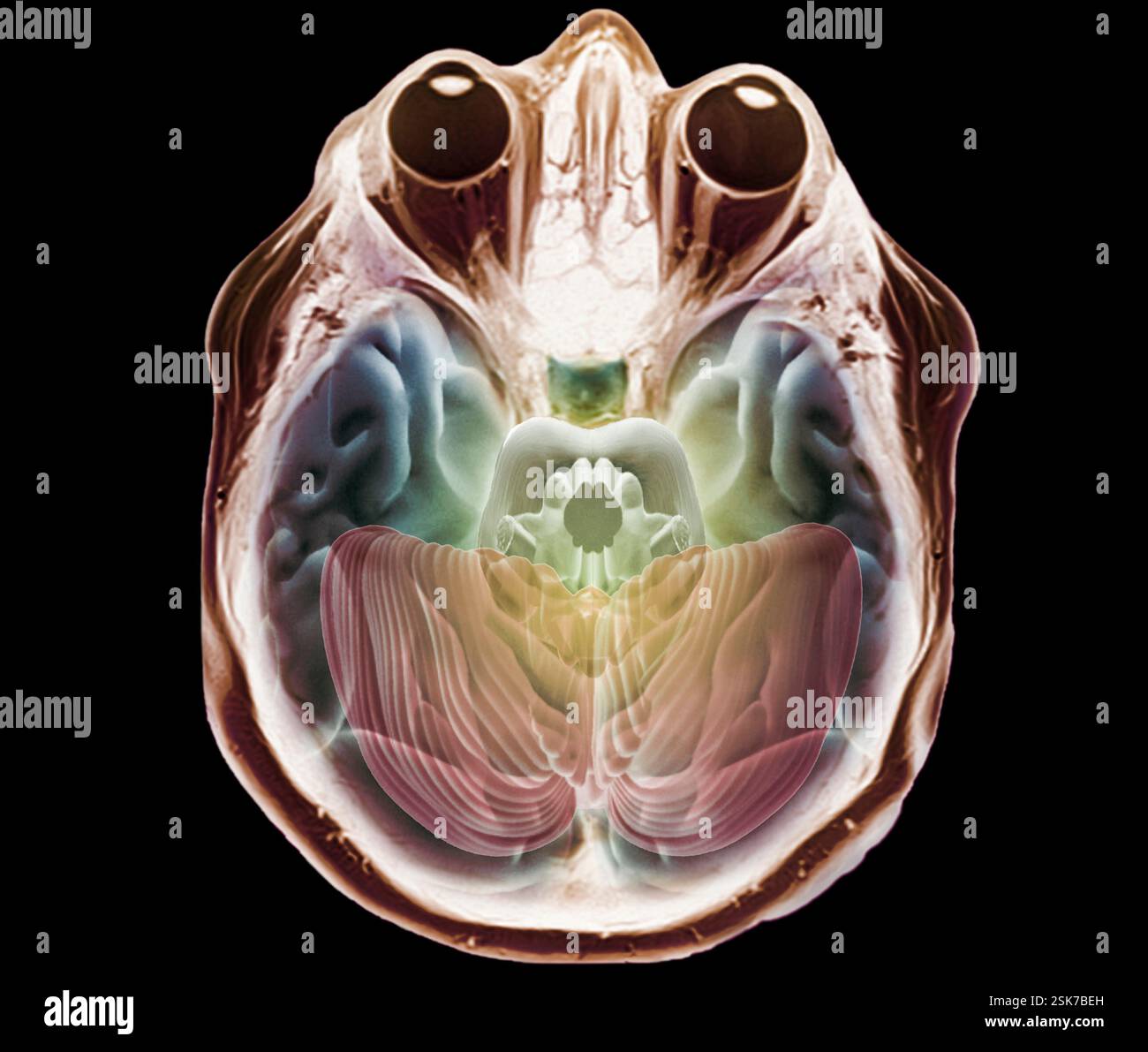 Human brain and eyes. Coloured 3D magnetic resonance imaging (MRI) scan of a normal human brain ...
