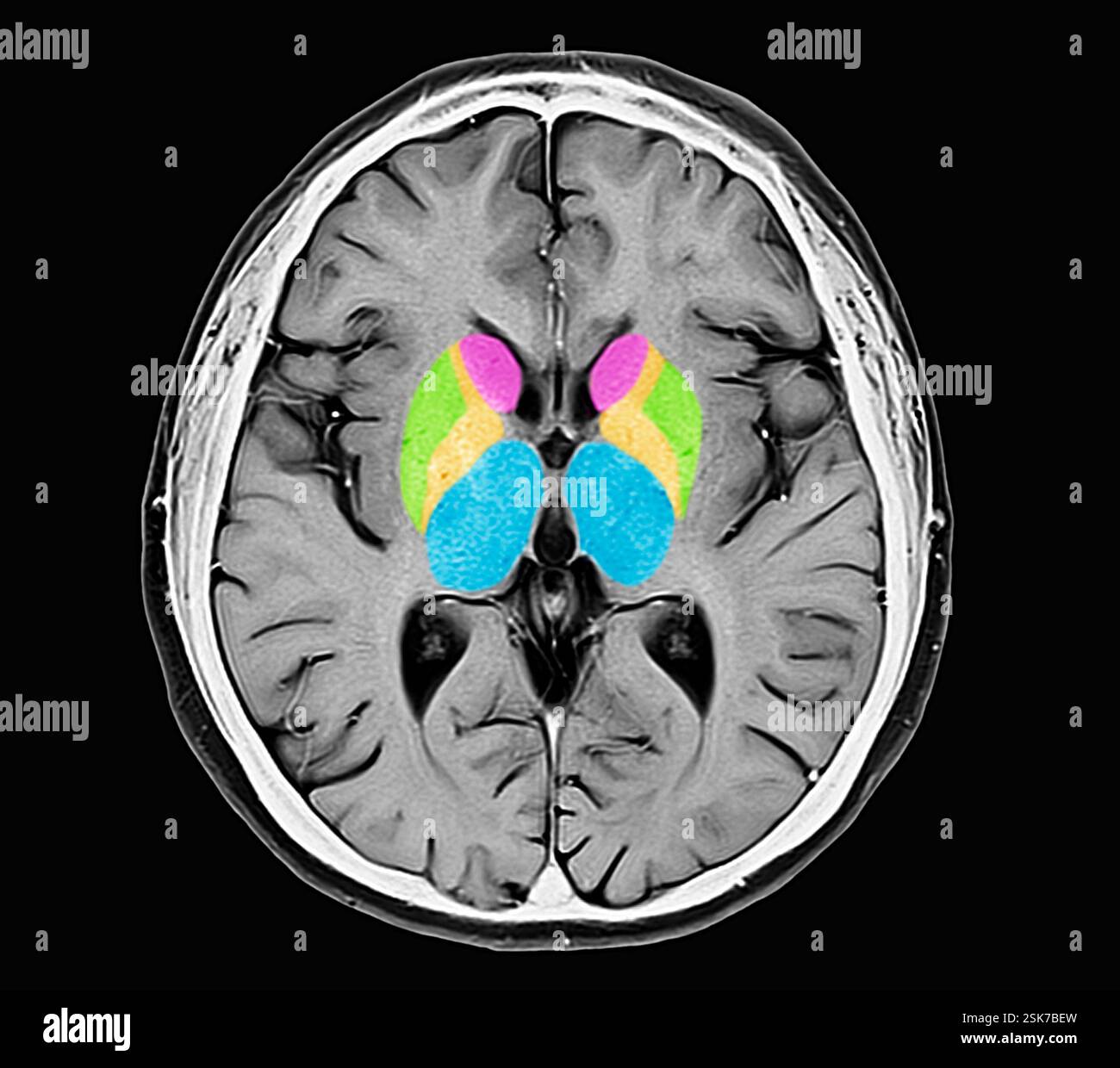 Human brain. Coloured axial magnetic resonance imaging (MRI) scan of the normal brain of a 30 ...