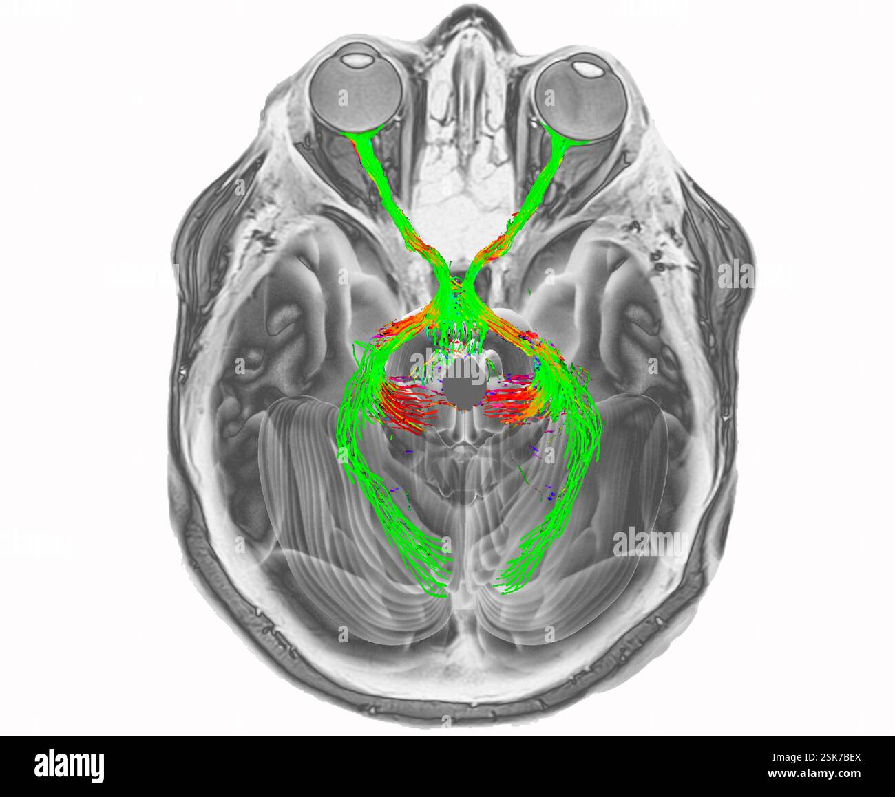 Optic chiasma. 3D diffusion tensor imaging (DTI) magnetic resonance imaging (MRI) scan of a ...