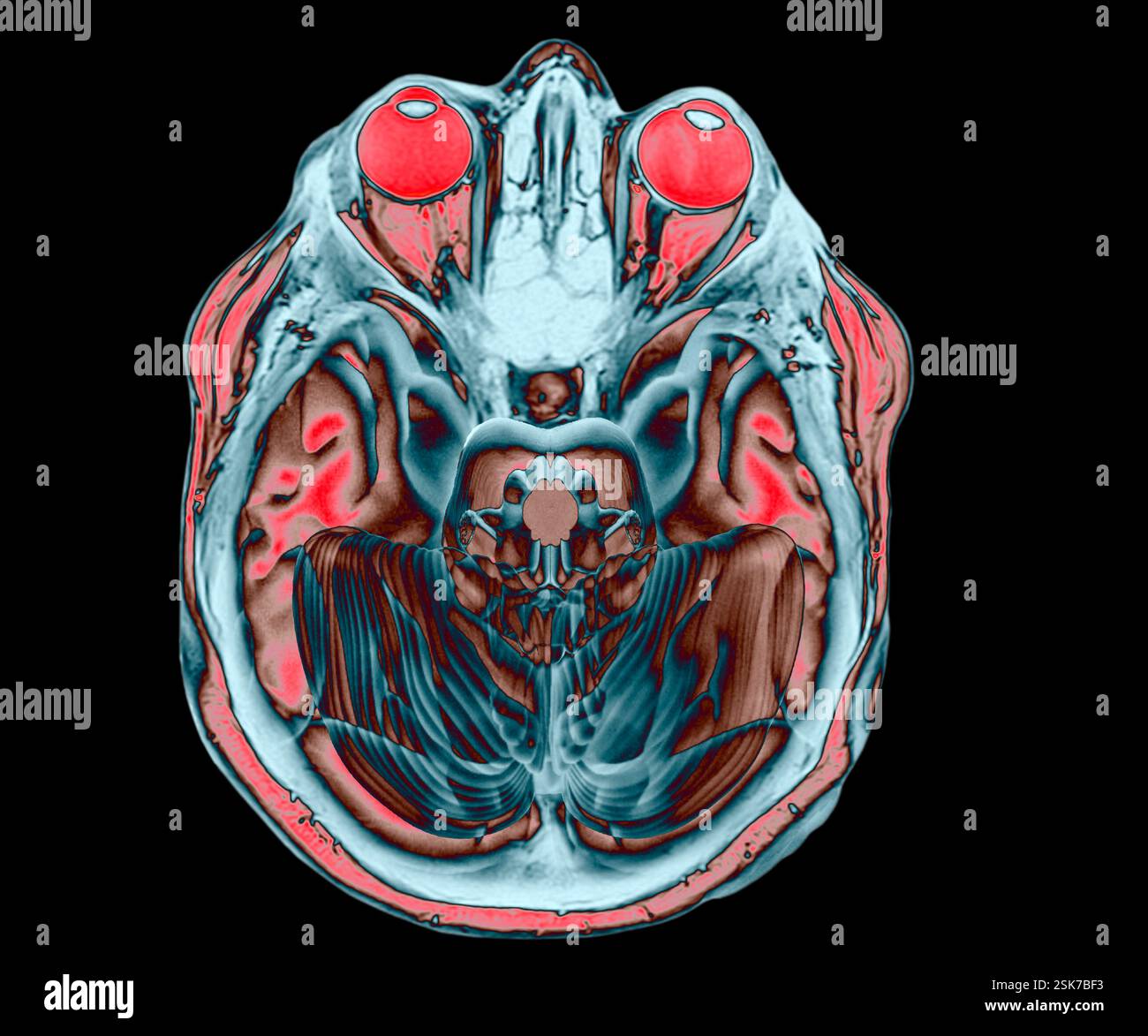 Human brain and eyes. Coloured 3D magnetic resonance imaging (MRI) scan of a normal human brain ...