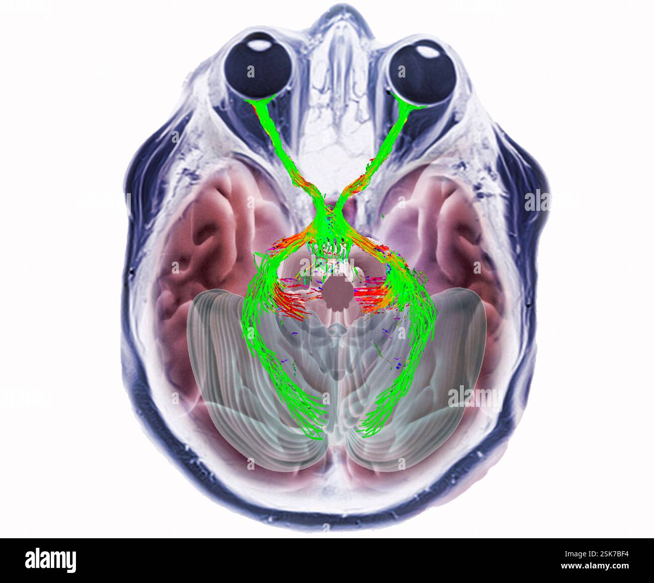 Optic chiasma. 3D diffusion tensor imaging (DTI) magnetic resonance imaging (MRI) scan of a ...