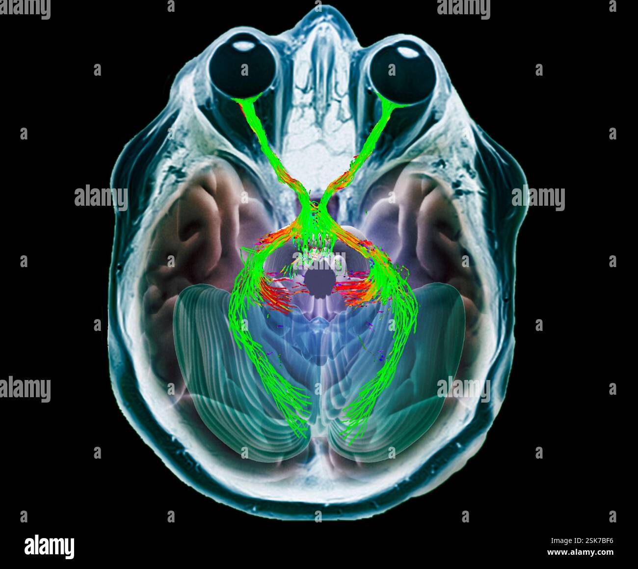 Optic chiasma. 3D diffusion tensor imaging (DTI) magnetic resonance imaging (MRI) scan of a ...
