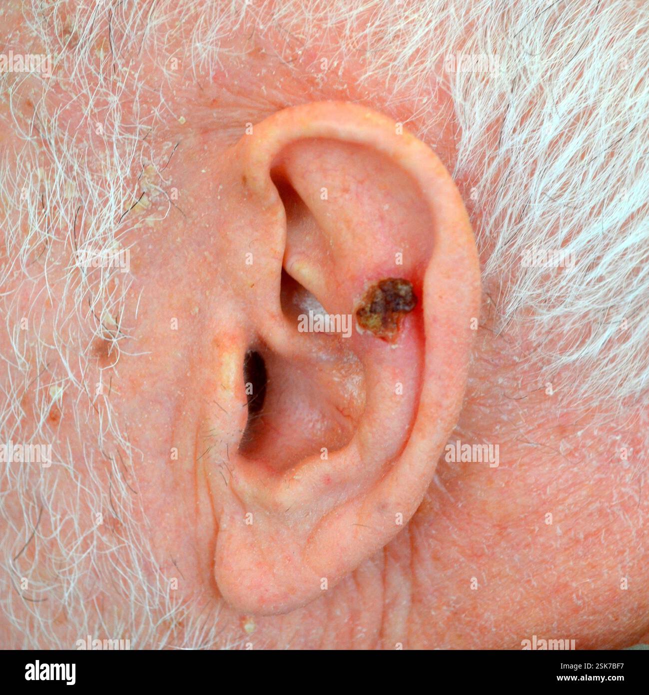 Basal cell carcinoma on the ear of a 74-year-old man. This common ...