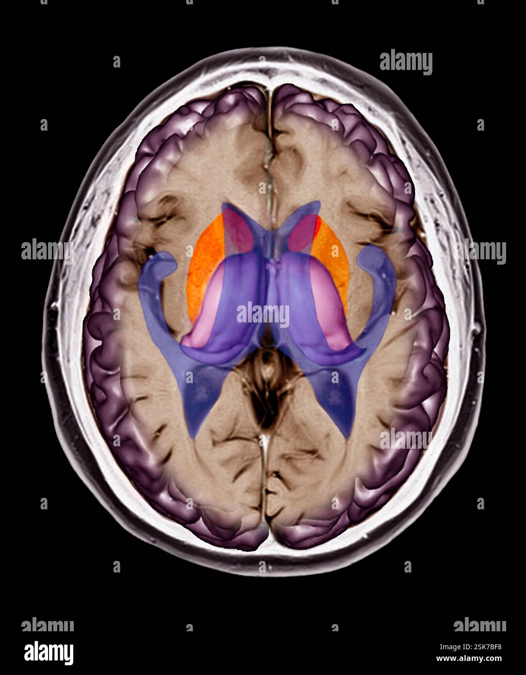 Human brain. Coloured 3D axial magnetic resonance imaging (MRI) scan of a normal human brain ...
