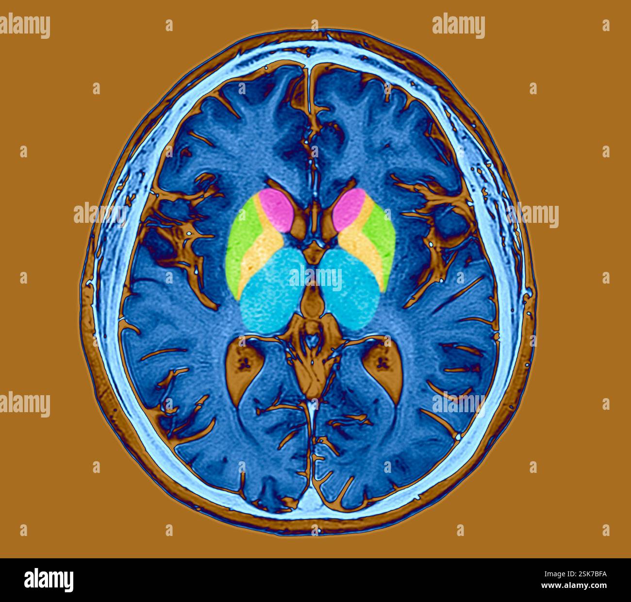 Human brain. Coloured axial magnetic resonance imaging (MRI) scan of the normal brain of a 30 ...