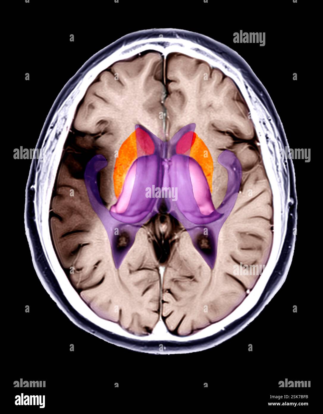 Collapsed lung, axial chest CT scan Stock Photo - Alamy