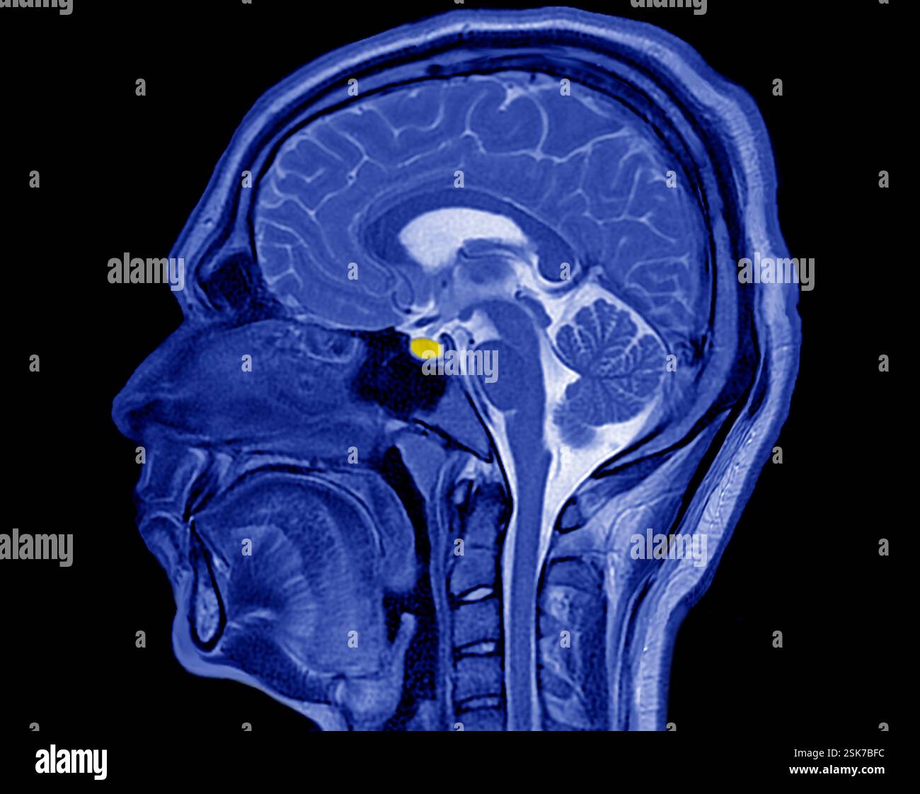 Sarcoidosis of the lungs, axial CT scan Stock Photo - Alamy