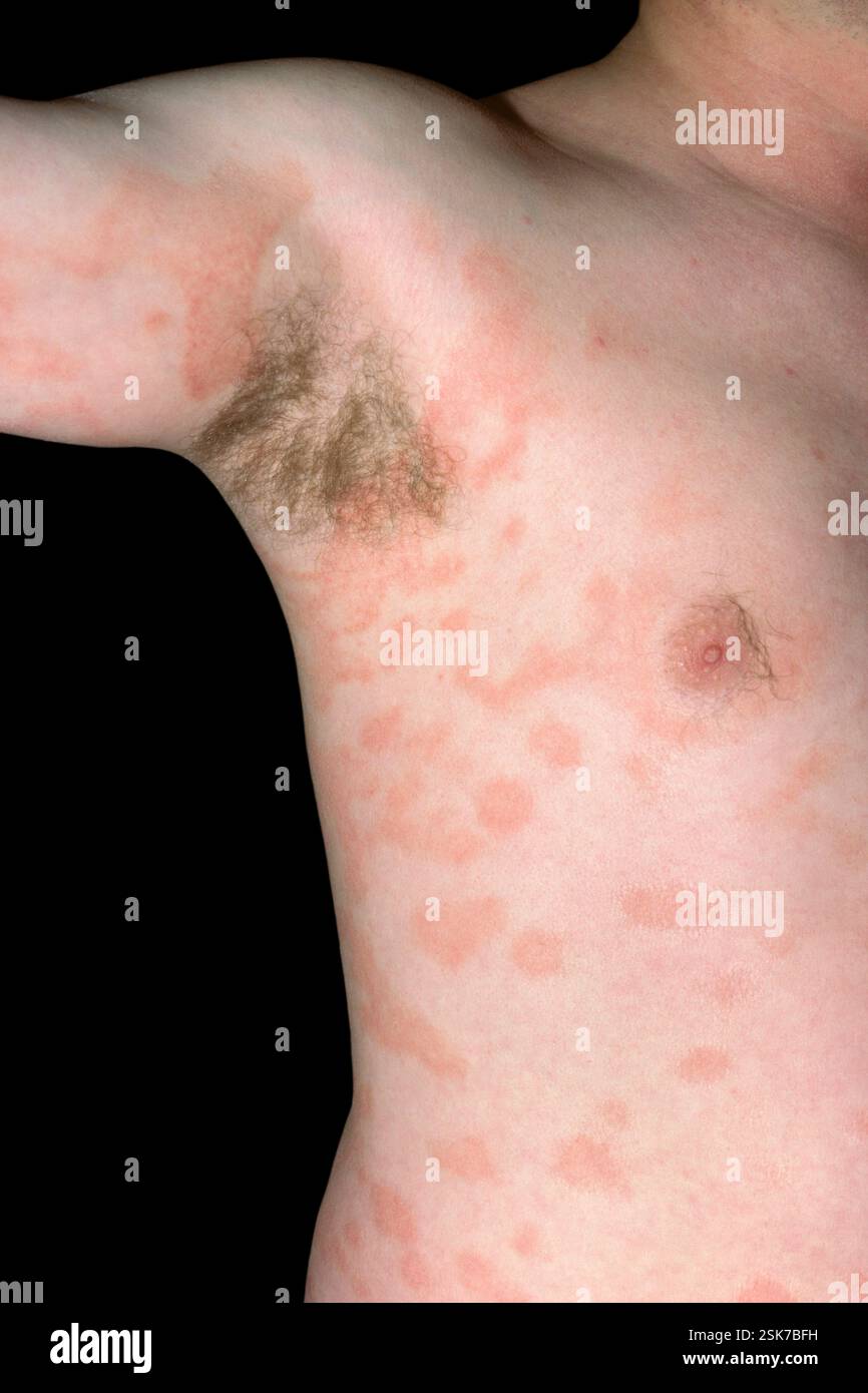 Plaque parapsoriasis lesions on the chest and shoulder of a 40-year-old ...