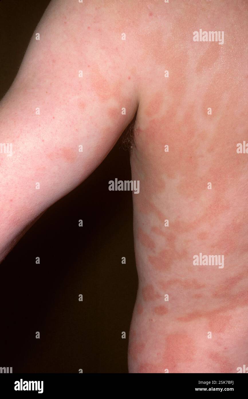 Plaque parapsoriasis lesions on the back and arm of a 40-year-old man ...