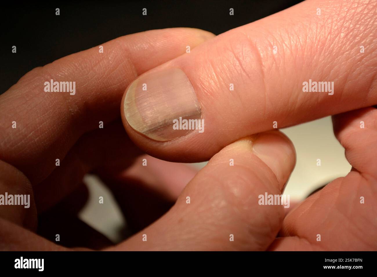 Malignant melanoma on the fingernail of a 60-year-old man. Melanoma is ...