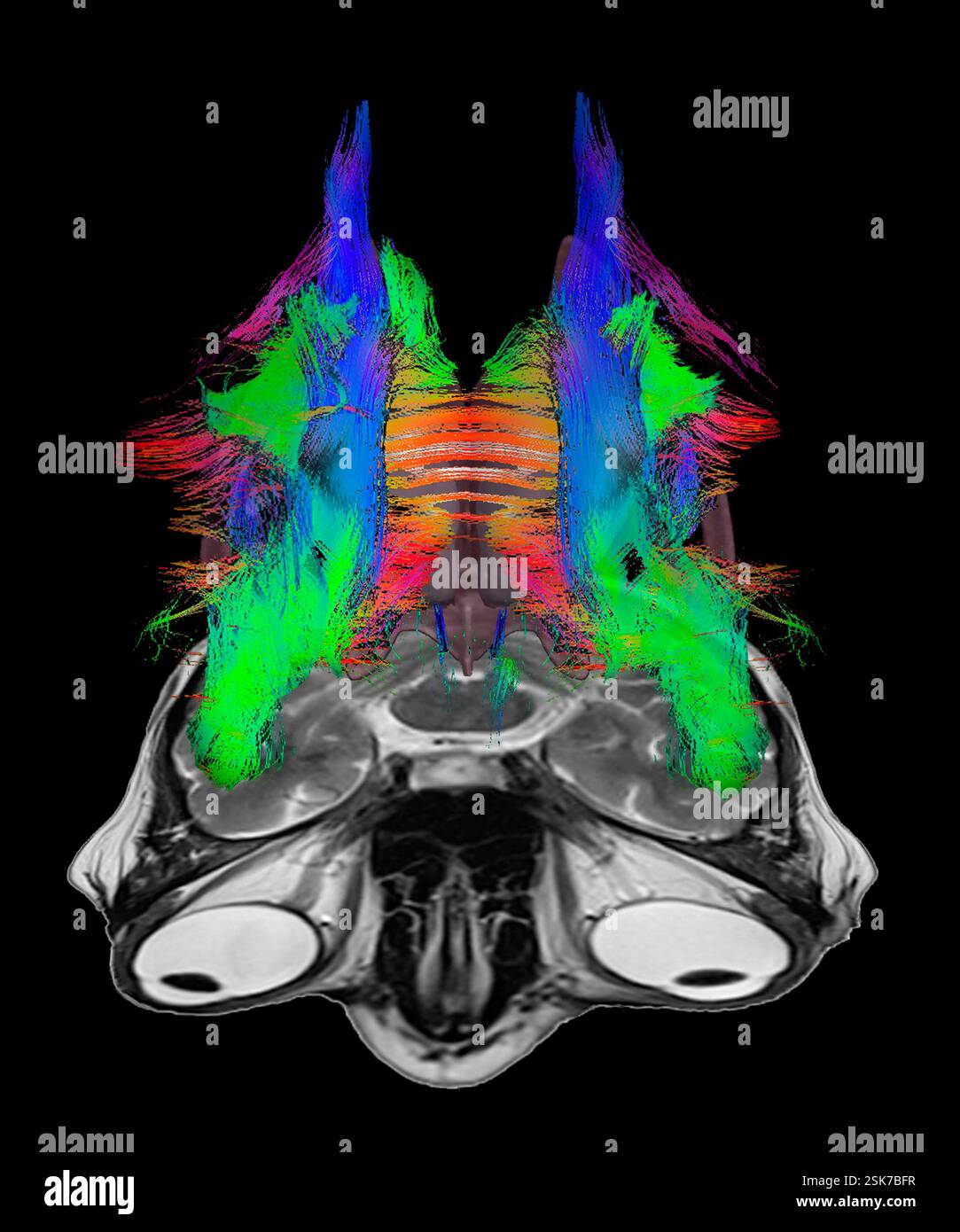Brain fibres and eyeballs. 3D diffusion tensor imaging (DTI) magnetic resonance imaging (MRI ...