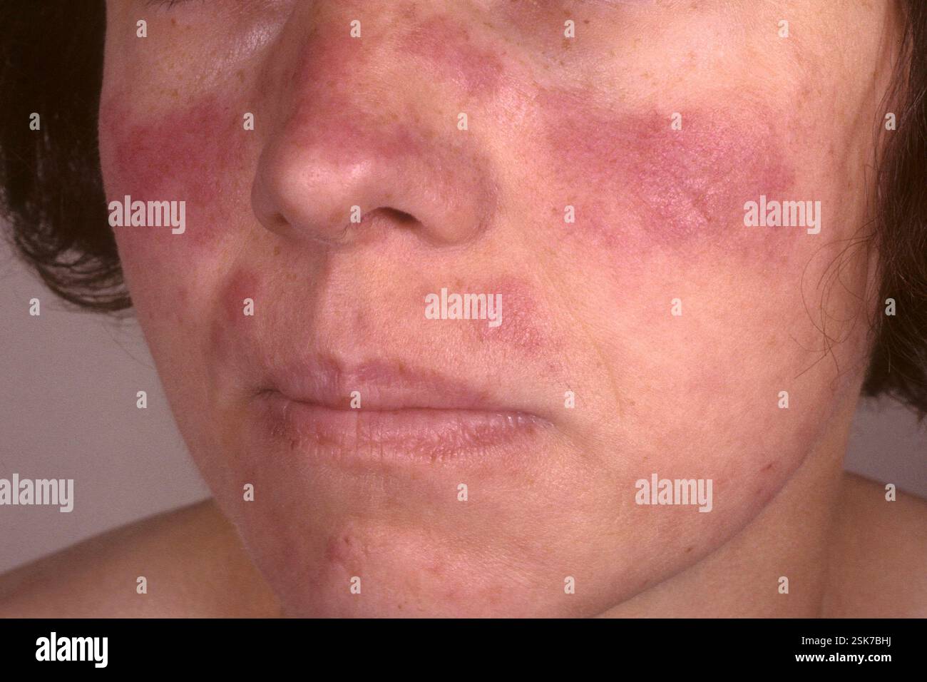 Rash on the face of a 50-year-old female patient with systemic lupus ...