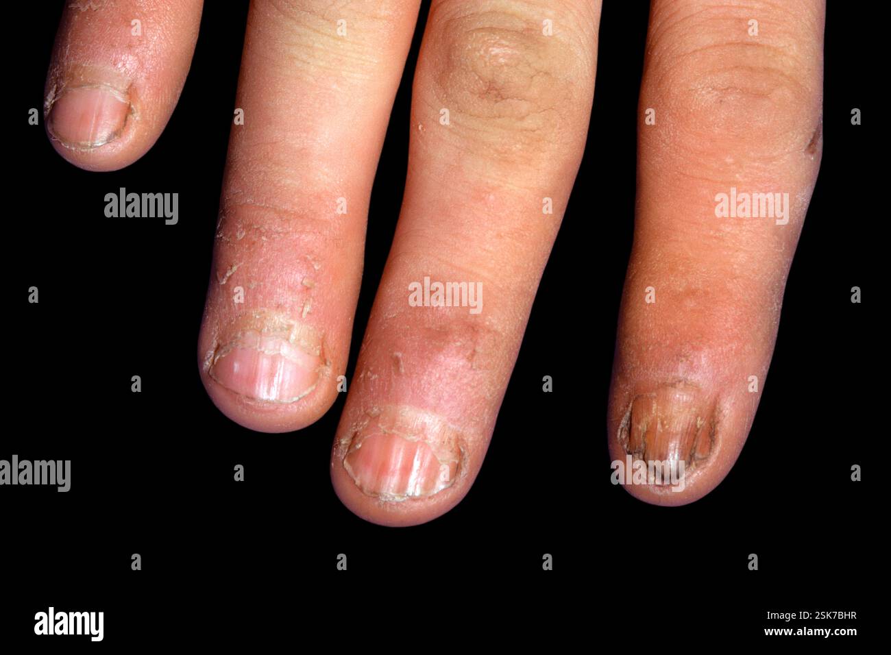 Cutaneous lesion on the hand nails (onychodystrophy) in an ...