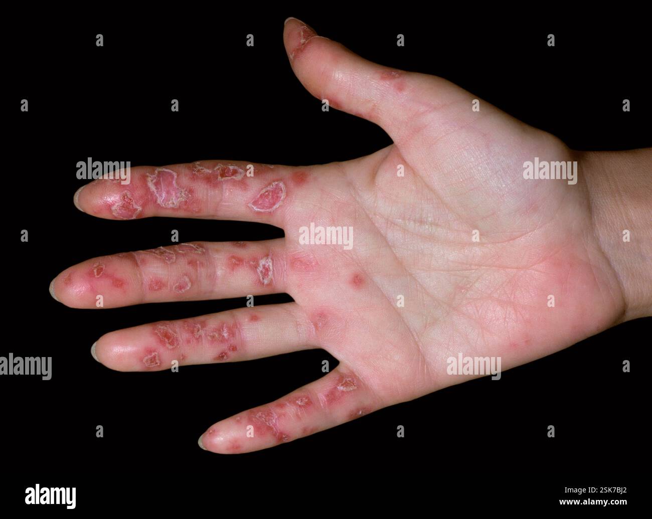Lesions on the hand of a 30-year-old female patient with subacute lupus ...