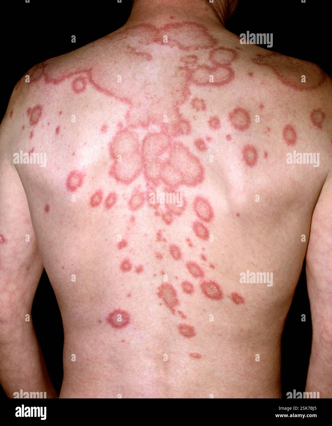 Lesions on the body of a 29-year-old patient with subacute lupus ...