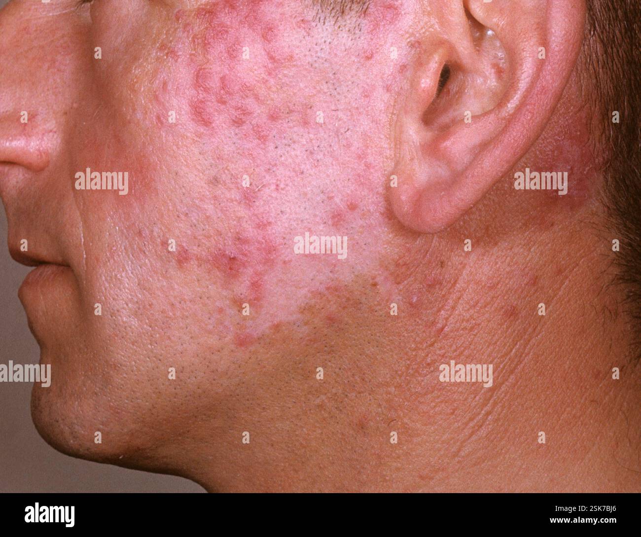 Lesions on the face of a 50-year-old male patient with chronic ...