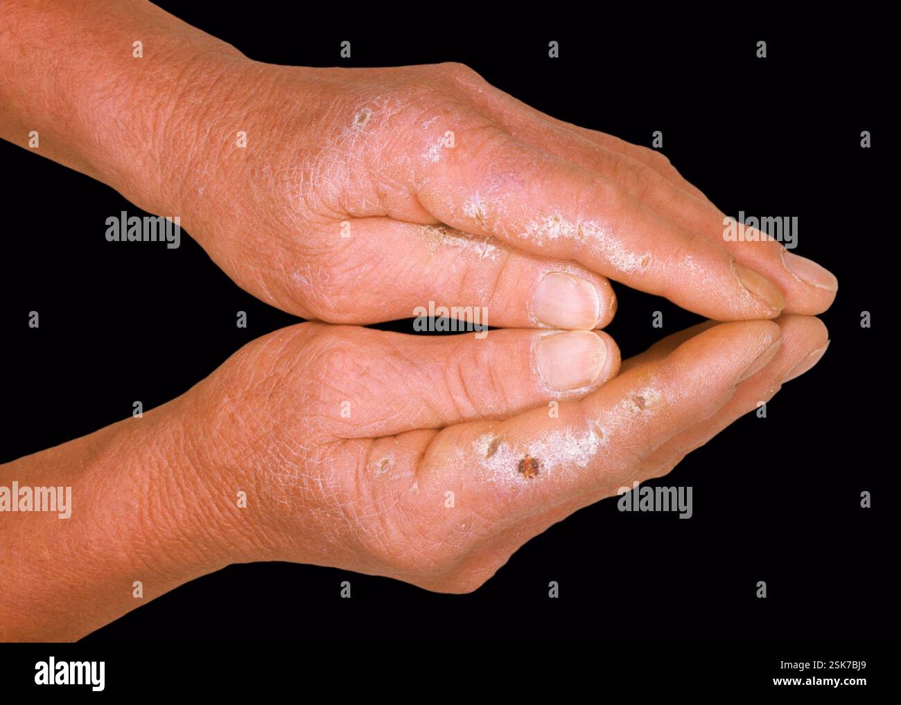Lesions on the hands of a 50-year-old male patient with chronic ...
