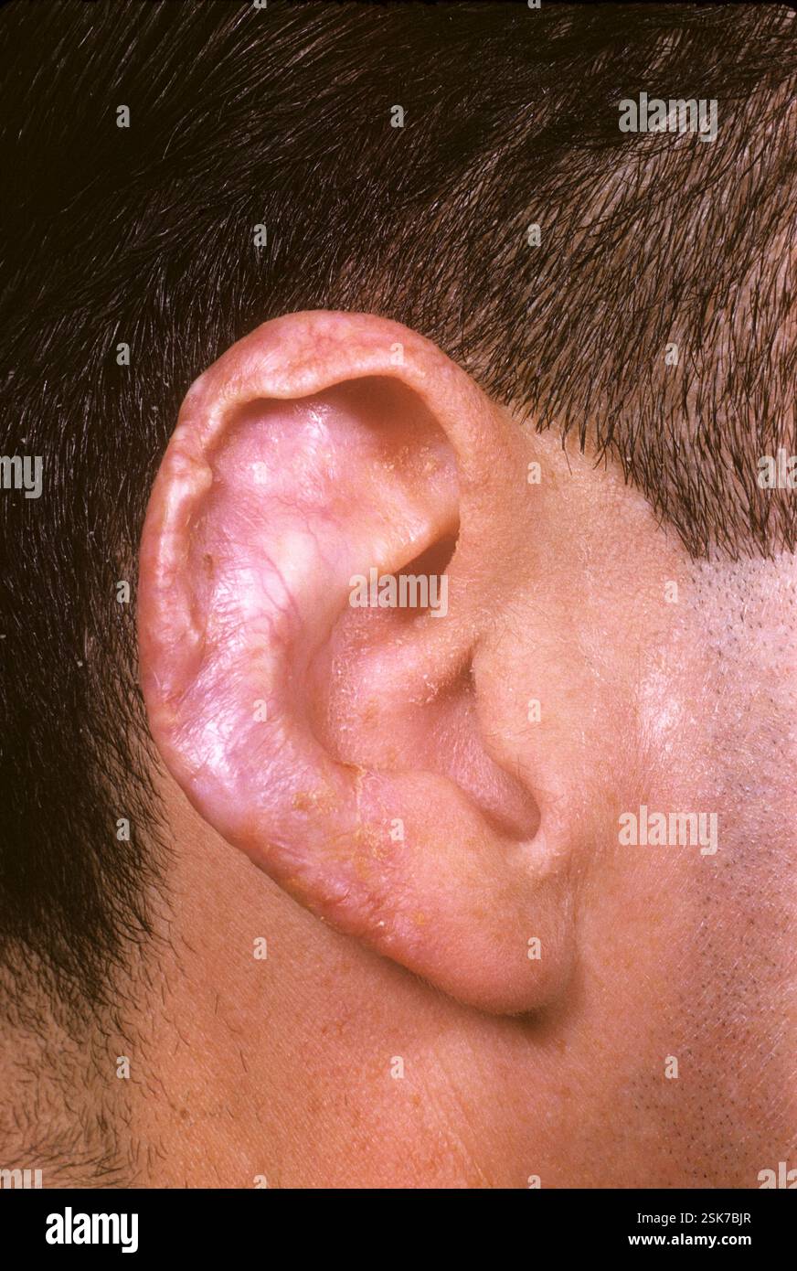 Lesions on the ear of a 50-year-old male patient with chronic cutaneous ...