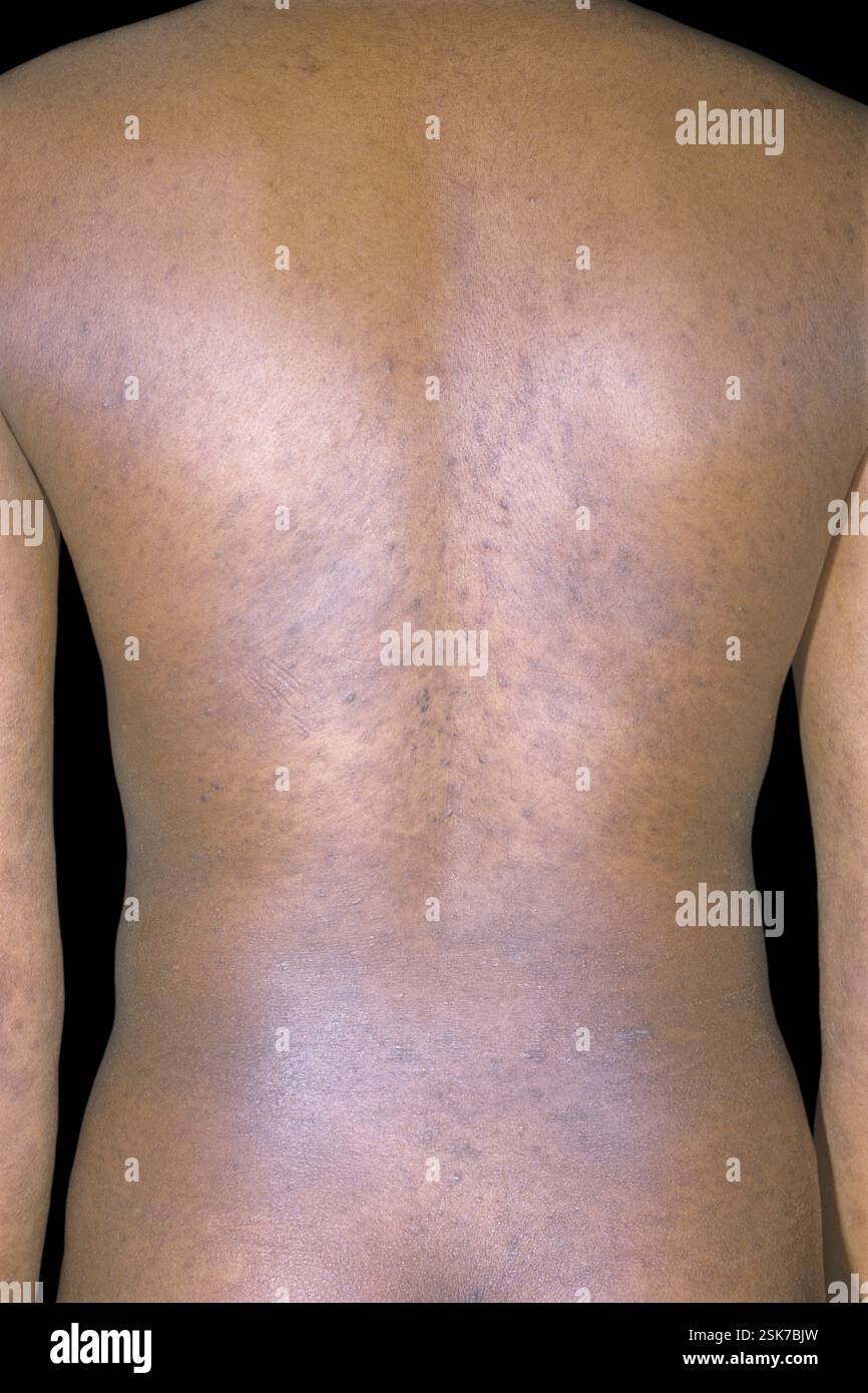 Lichen planus pigmentosus. Close-up of the back of a 30-old-year black ...