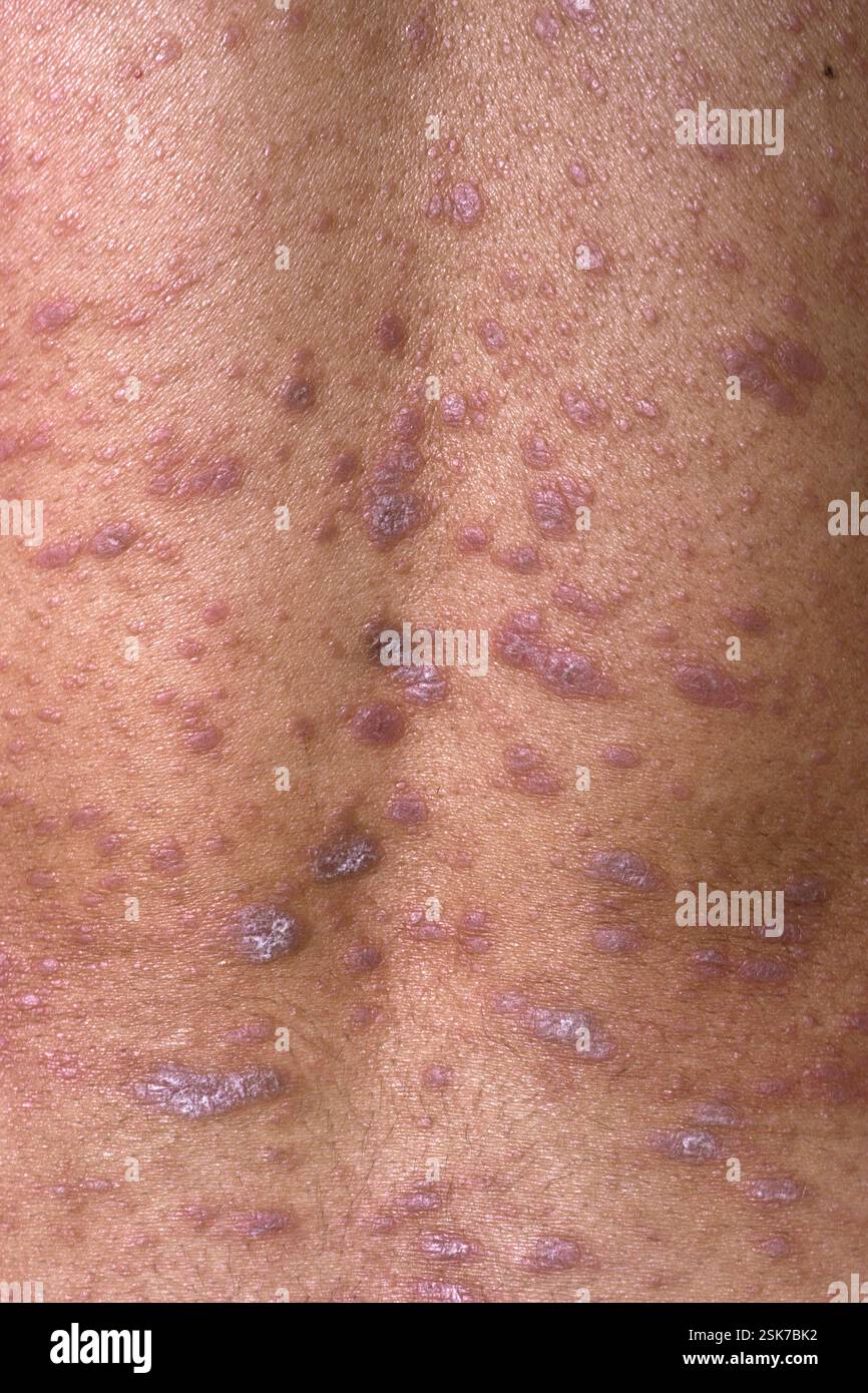 Lichen planus. Close-up of the back of a 30-old-year female patient ...