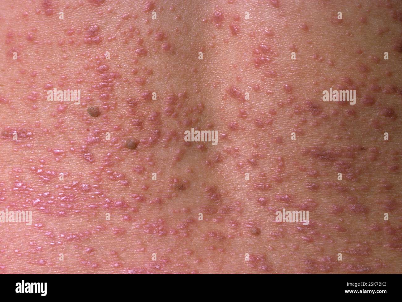 Lichen planus. Close-up of the back of a 38-old-year female patient ...