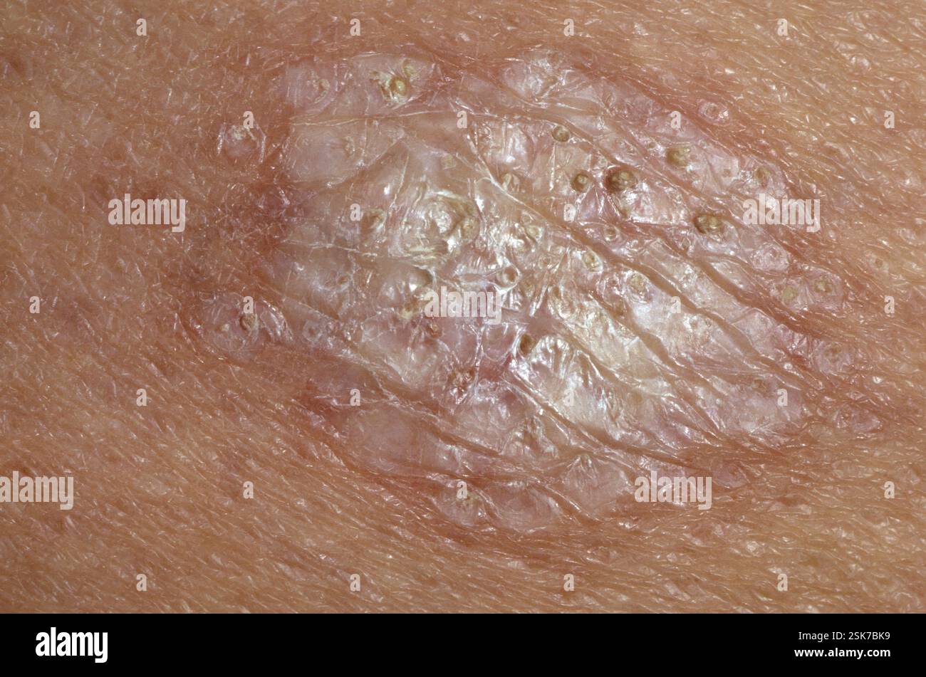 Lichen sclerosus. Close-up of a lesion on the skin of a 44-old-year ...