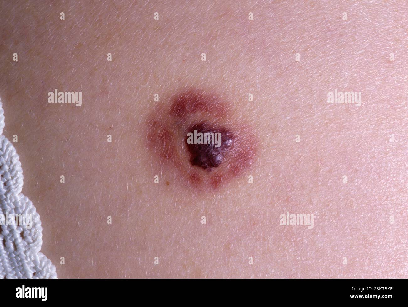 Haemolymphangioma. Close-up of a haemolymphangioma on the skin of a 32 ...