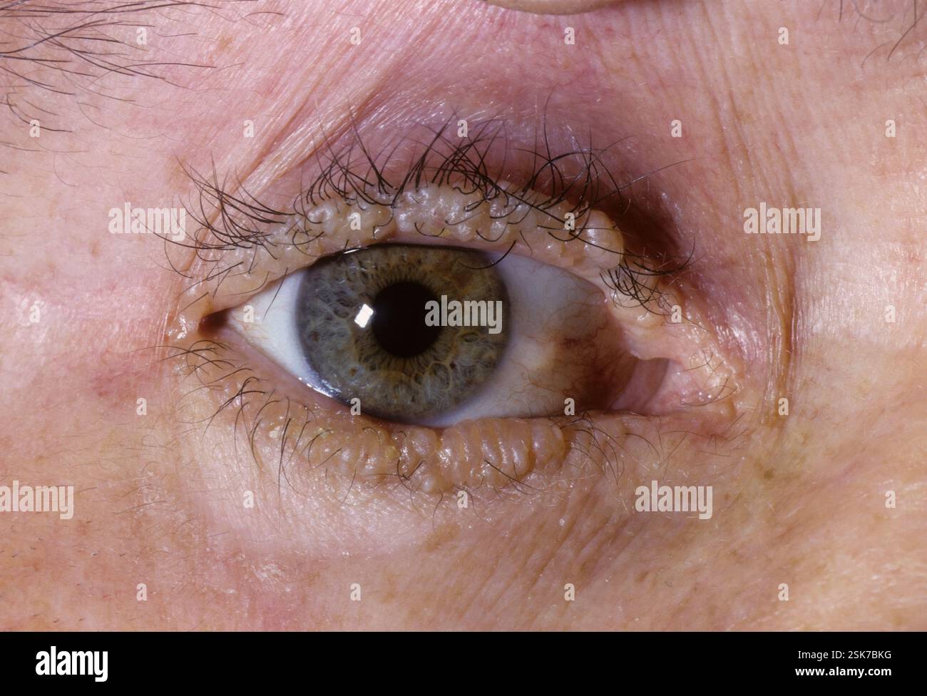 Hyalinosis of the eyelid. Close-up of the eye of a 40-year-old male ...