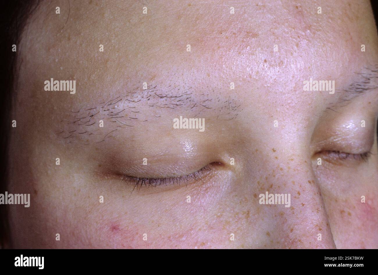 Hair loss in monilethrix. Bald eyebrows of a 20-year-old female patient ...