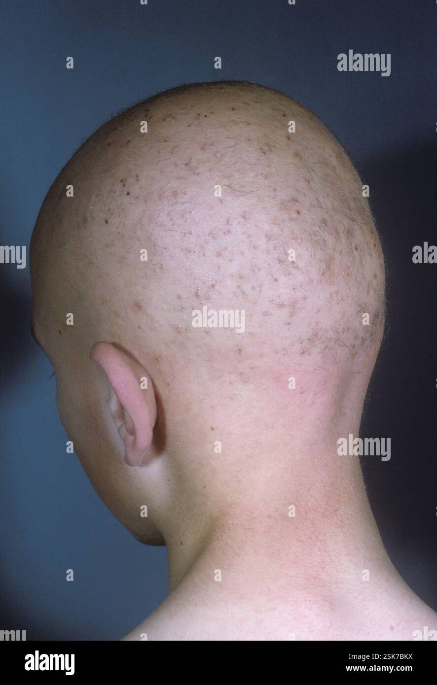 Hair loss in monilethrix. Bald scalp of a 19-year-old male patient with ...