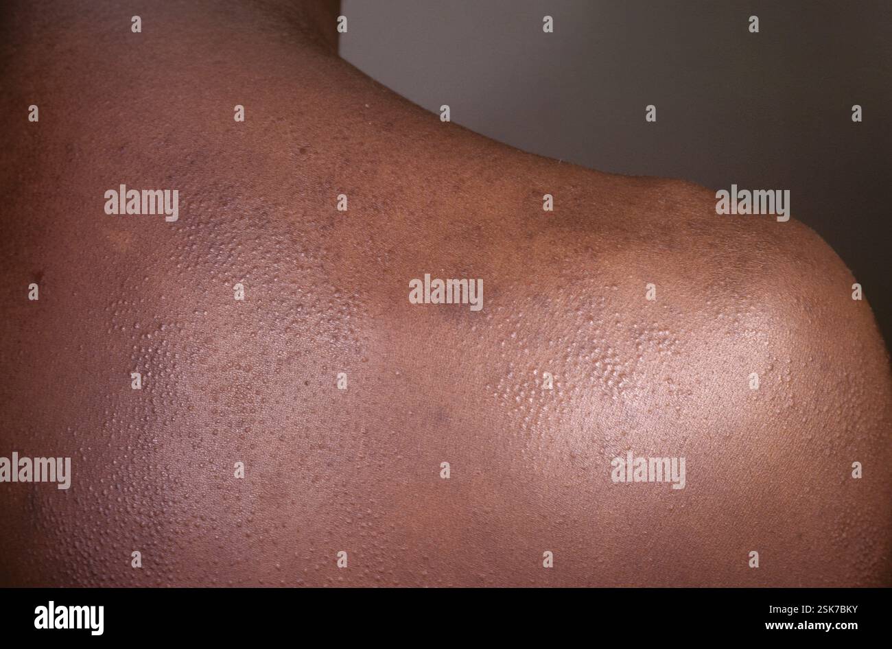 Follicular mucinosis. Close-up of a rash on the back and shoulder of a ...