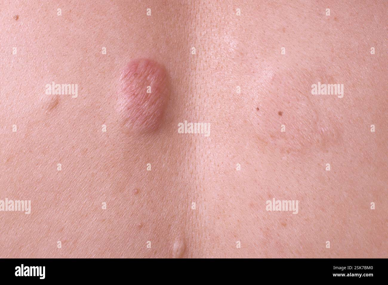 Anetoderma. Close-up of lesions on the back of a 33-year-old female ...