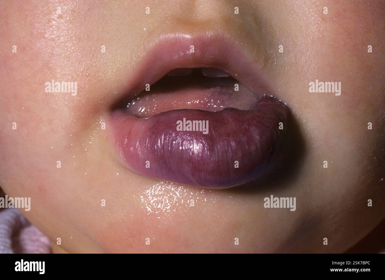 Haemangioma. Immature haemangioma (strawberry naevus) on the lower lip ...