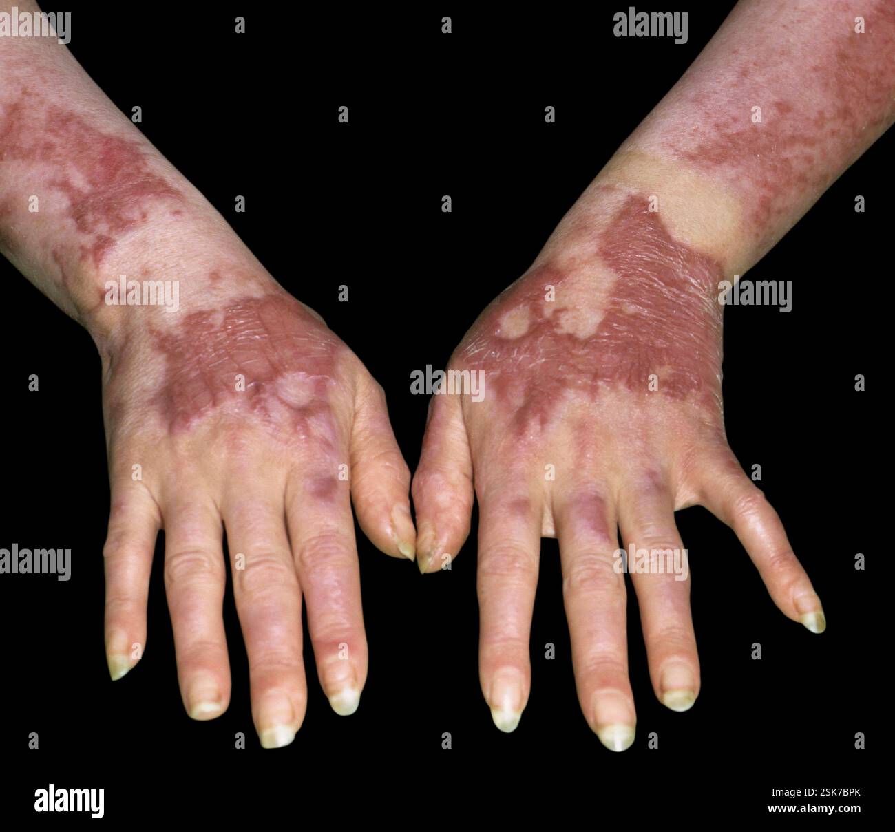 Keloid scarring in burn. Close-up of extensive keloid scarring on the ...