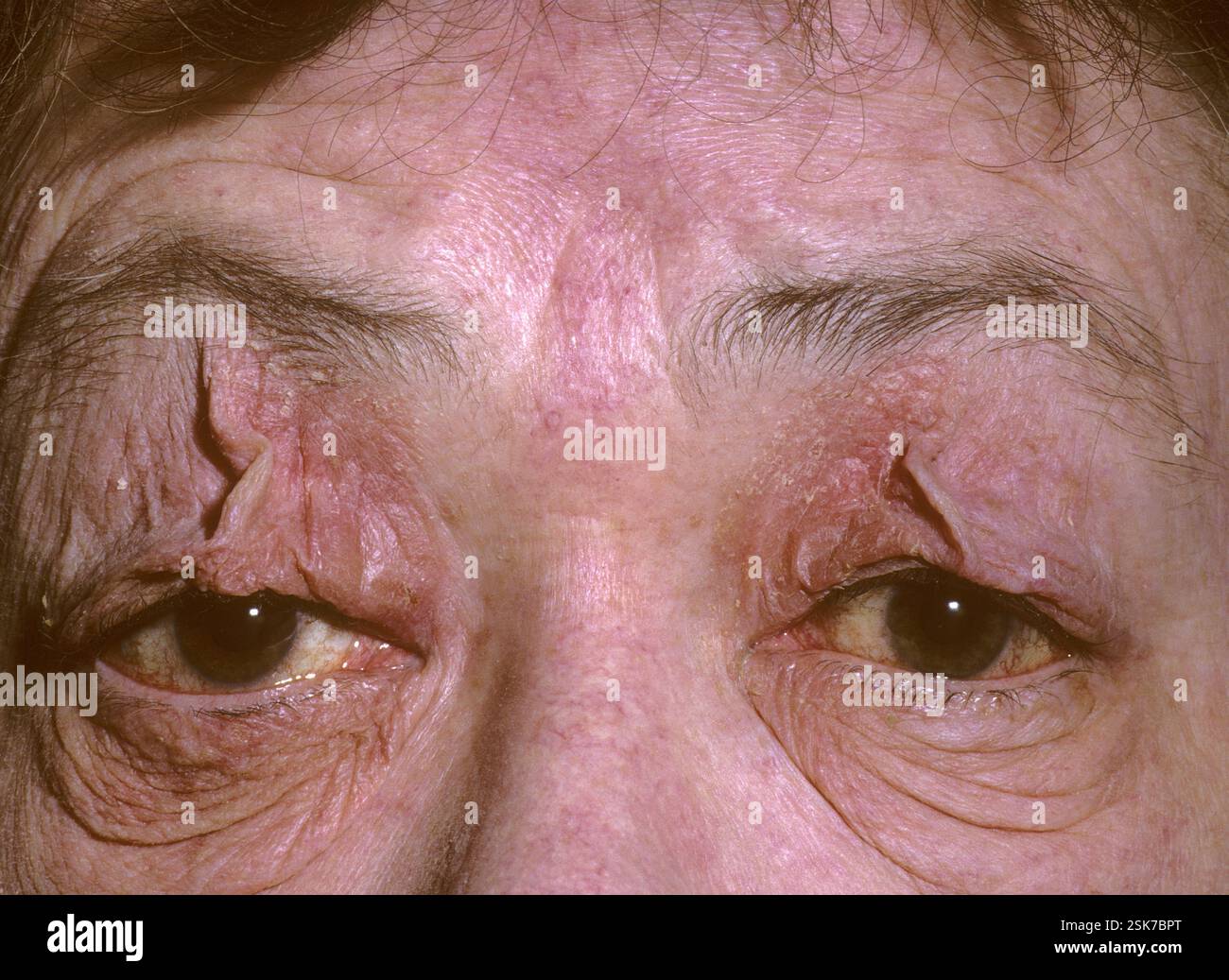 Chalazoderma. Close-up of loose skin around the eyelids of a 60-year ...