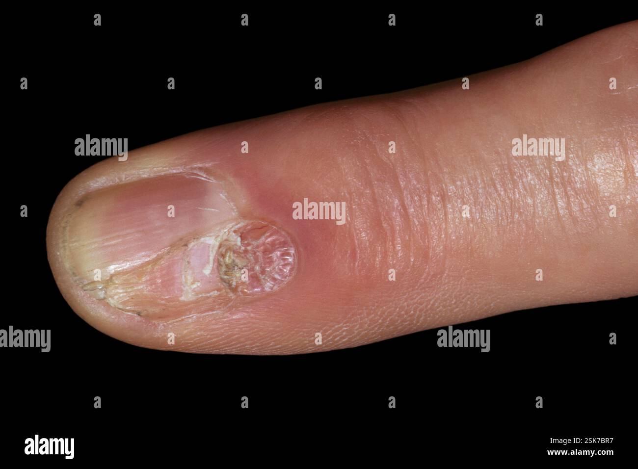 Myxoid pseudocyst. Close-up of a mucoid pseudocyst on the finger of a ...