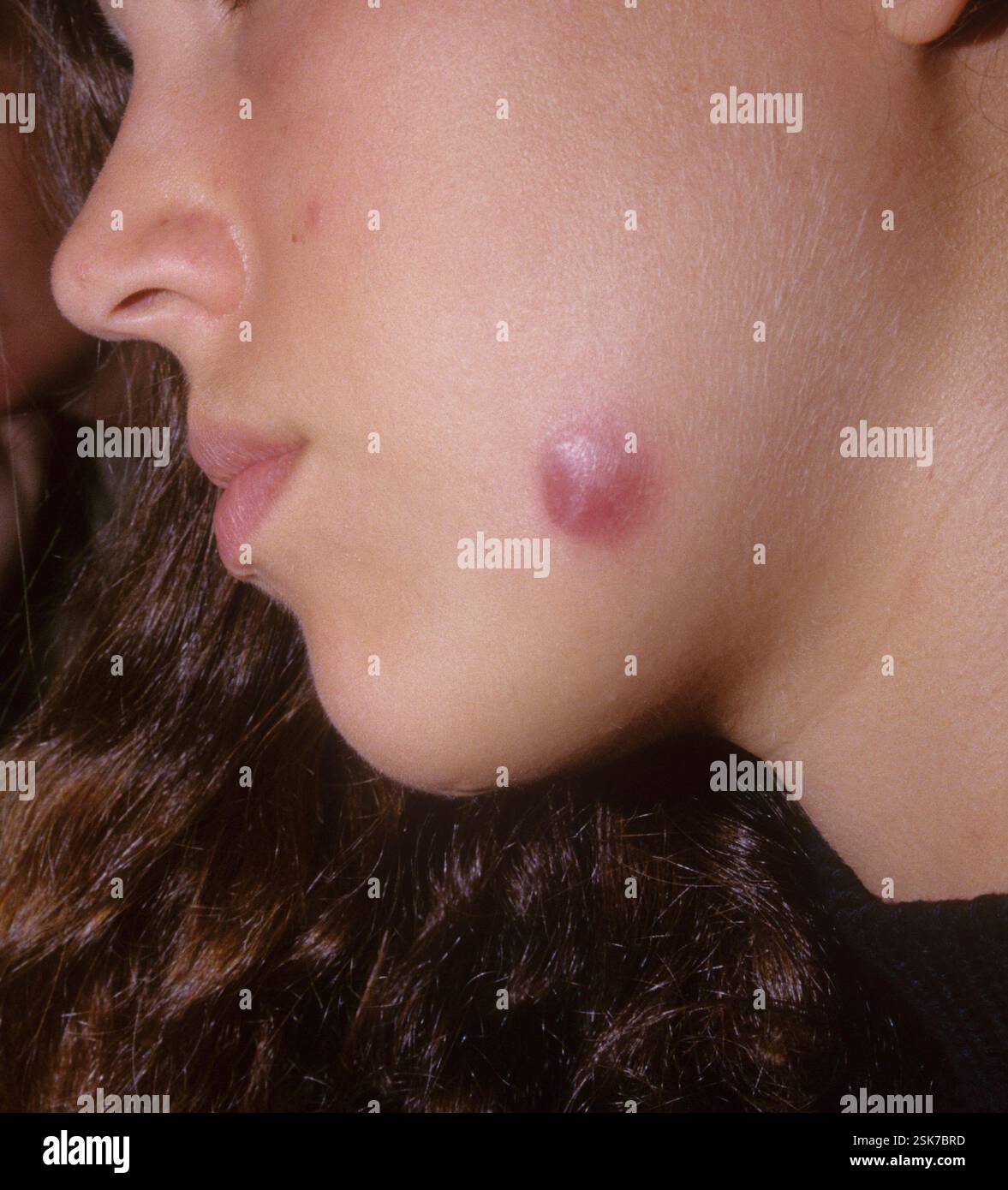 Dental fistula. Close-up of discoloured lump on the cheek of a 19-year ...