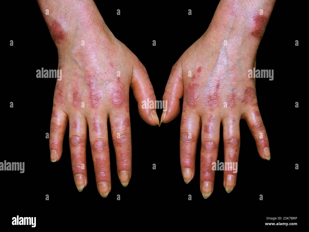 Lupus erythematosus. Close-up of scaly skin patches on the hands of a ...