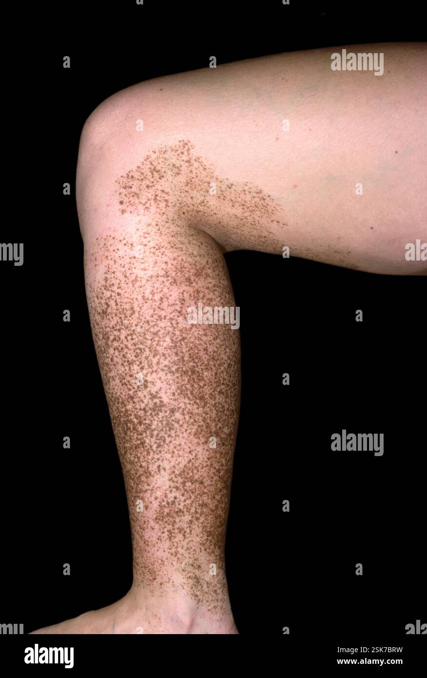 Verrucous epidermal hamartoma. Close-up of a rash on the leg of a 44-year-old female patient ...