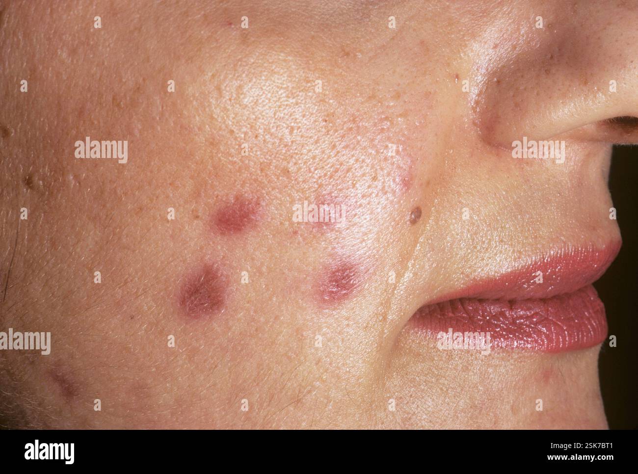 Lupus erythematosus. Close-up of a rash on the face of a 35-year-old ...