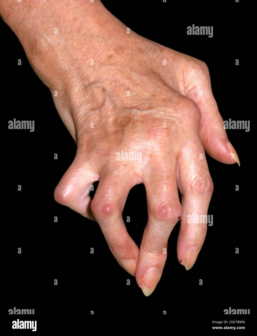 Rheumatoid arthritis. Close-up of the deformed right hand of a 72-year ...