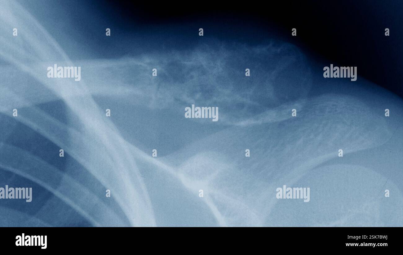 Ewing's sarcoma. Coloured frontal X-ray of the left clavicle ...
