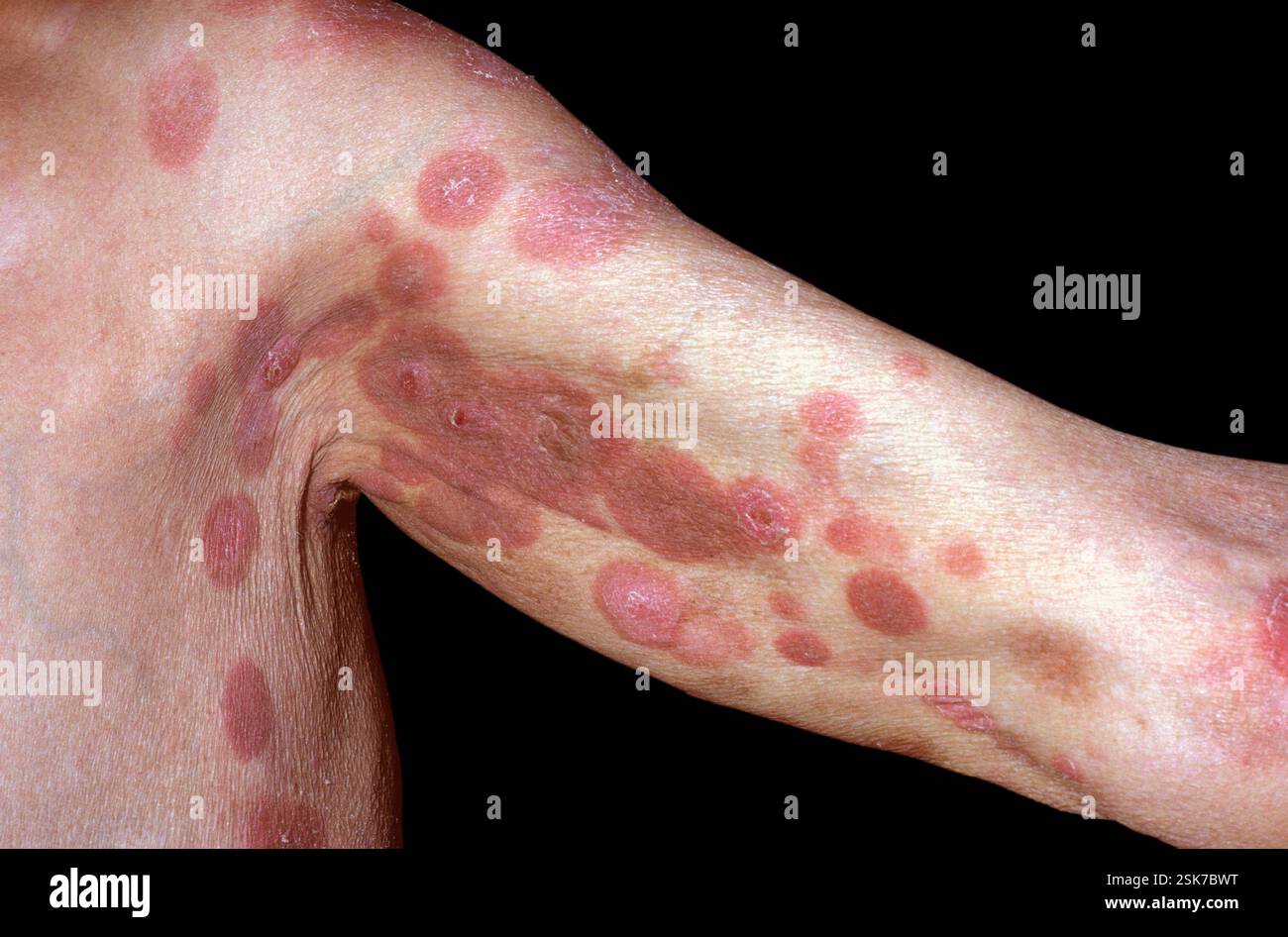 Mycosis fungoides. Close-up of lesions on the skin of a 40-year-old ...