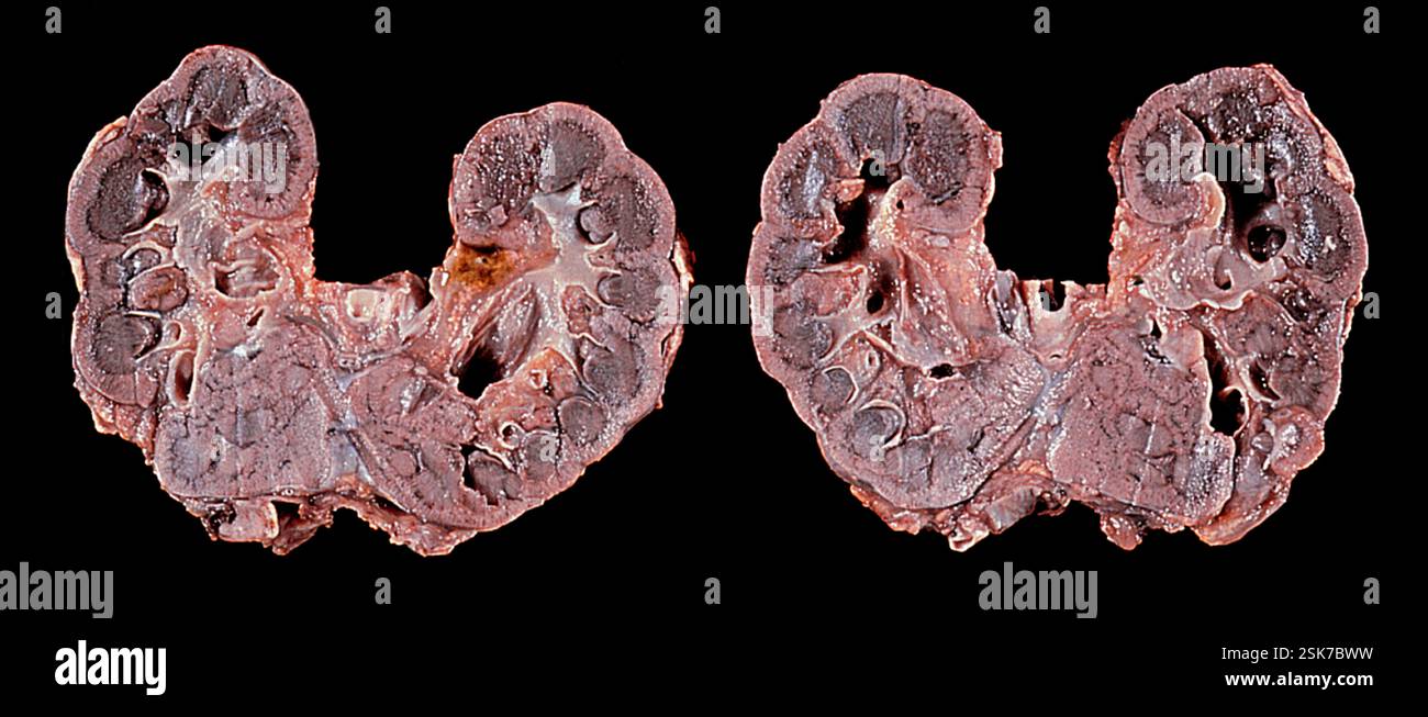 Horseshoe kidney. Pathological specimen of section through a horseshoe ...