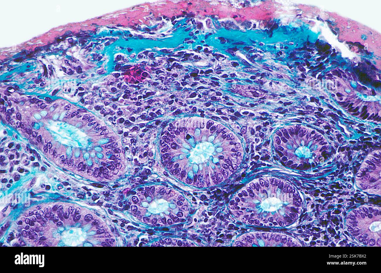 Collagenous colitis. Light micrograph of a section through a colon ...